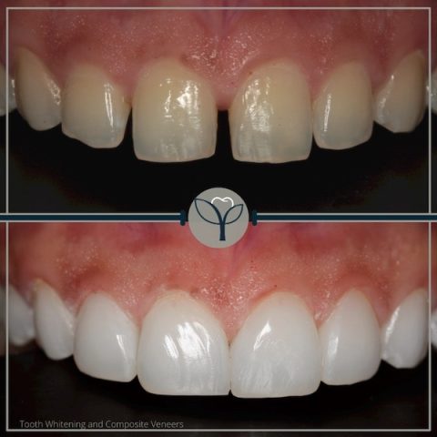 Dental Composite Bonding Manchester | Yor Dental