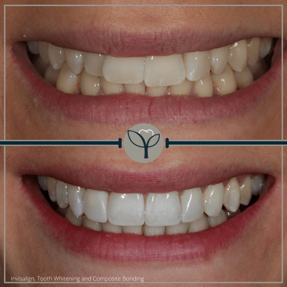 Smile Gallery: Cosmetic Dental Before and After Photos