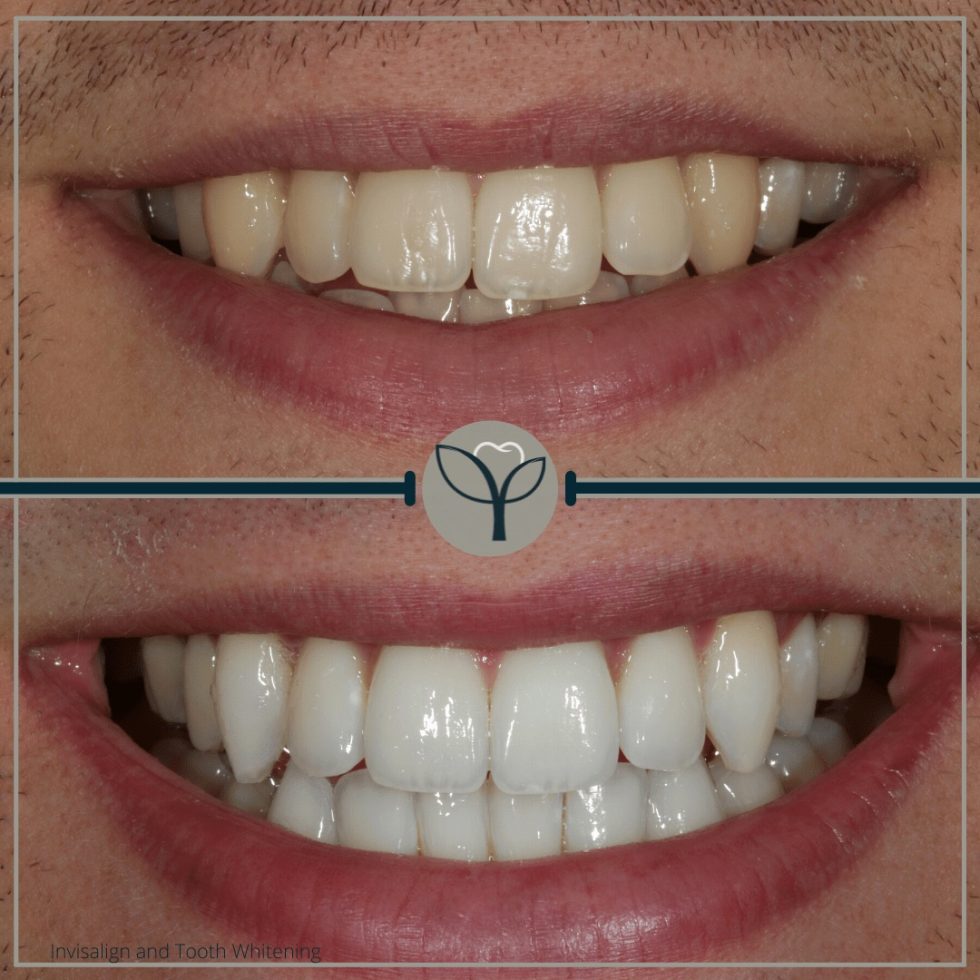 Smile Gallery: Cosmetic Dental Before and After Photos
