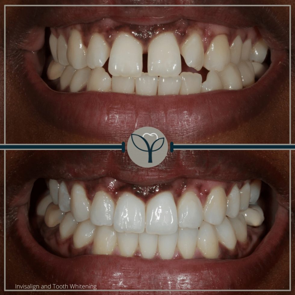 Smile Gallery: Cosmetic Dental Before and After Photos