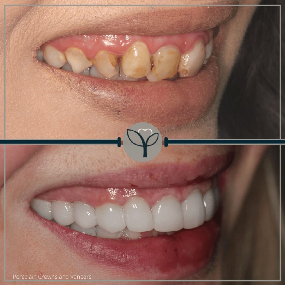 Smile Gallery: Cosmetic Dental Before and After Photos