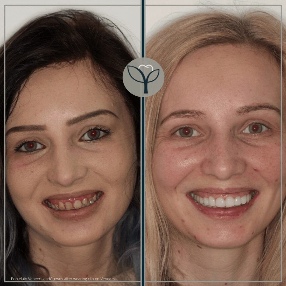Smile Gallery: Cosmetic Dental Before and After Photos